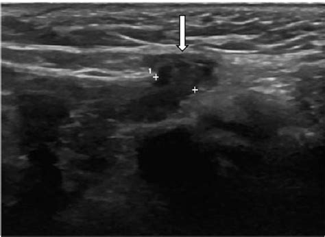 Figure 1 From Canal Of Nuck Hernias Semantic Scholar