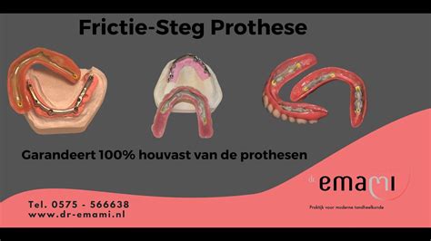 Frictie Steg Prothese Kunstgebit Klikgebit Implantaat Gehemelte