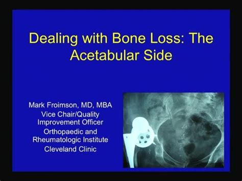 Dealing With Bone Loss The Acetabular Side Orthogate