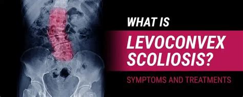Concave Vs Convex Scoliosis