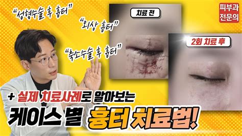 성형수술 흉터 및 외상흉터의 효과적인 제거 방법 치료 원리 치료사례 Youtube