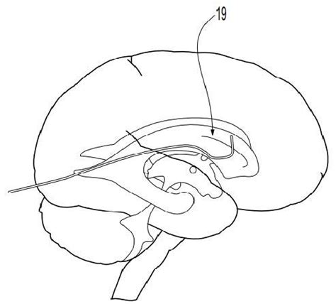 The Required Position From The Neurosurgeon To Place The Shunt In A Download Scientific Diagram