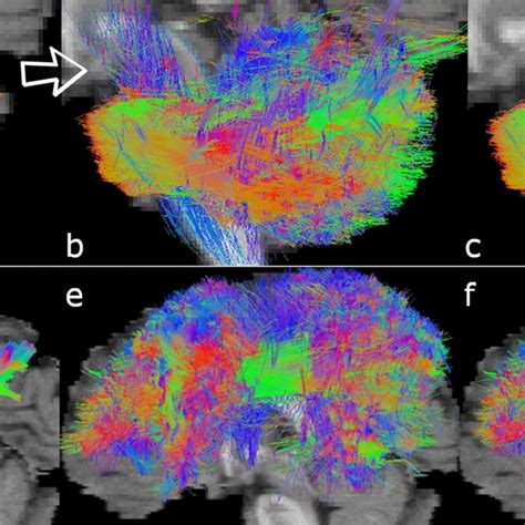 Erroneous Bundle Segmentation Examples A Ilf Red And Or Green