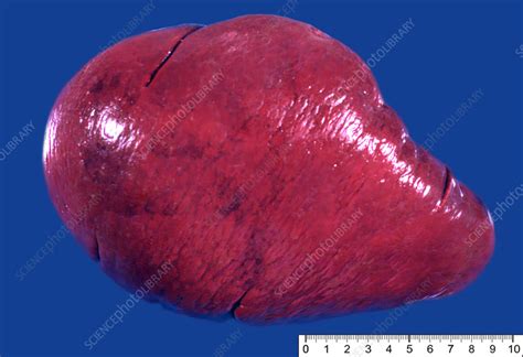 Splenomegaly Stock Image C059 7627 Science Photo Library