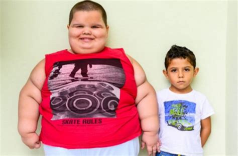Prader Willi Syndrome A Brazilian Weighs 80 Kg At 5 Years Old Ace Mind