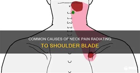 Common Causes Of Neck Pain Radiating To Shoulder Blade Medshun