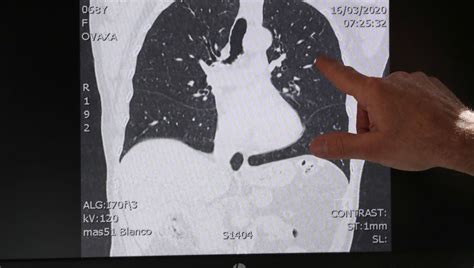 La Imagen De Cómo El Coronavirus Afecta A Los Pulmones De Los Pacientes