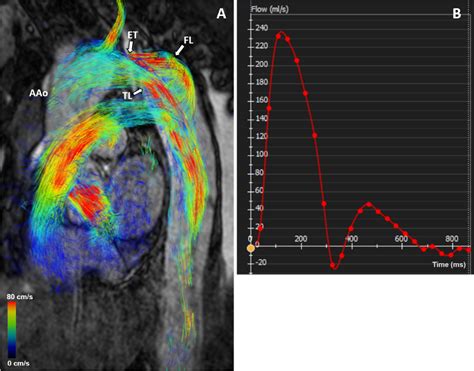 Figure 2 From Entry Tear Hemodynamics Using 4d Flow Mri In A Patient