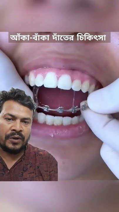 আঁকাবাঁকা দাঁতের ব্রেস রিমুভ করে দাঁতের আসল সৌন্দর্য ফুটিয়ে তোলা।