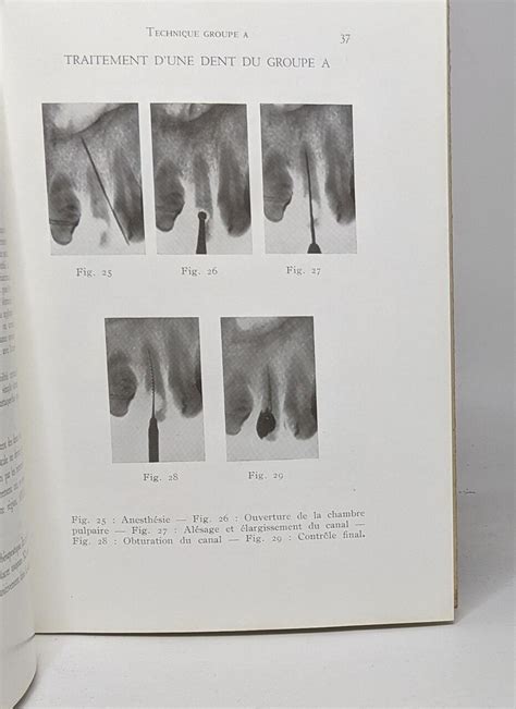 Traitement radiculaire par la méthode N2 chirurgie rationnelle de la