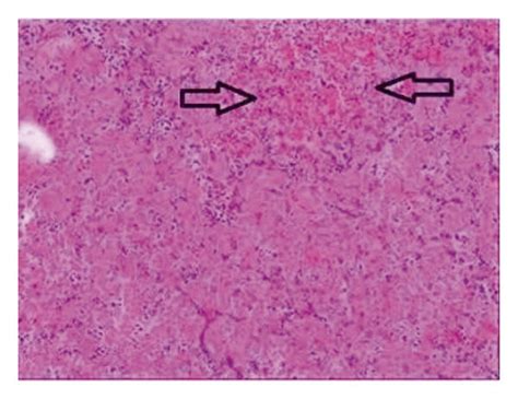 Histopathology Extensive Infarction Of A Pituitary Adenoma With