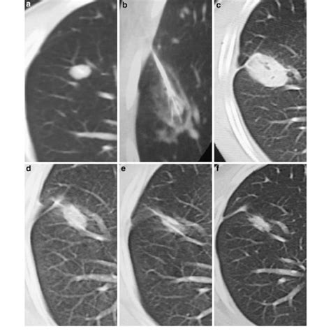 Sequential Computed Tomographic Ct Images Demonstrating The Usual