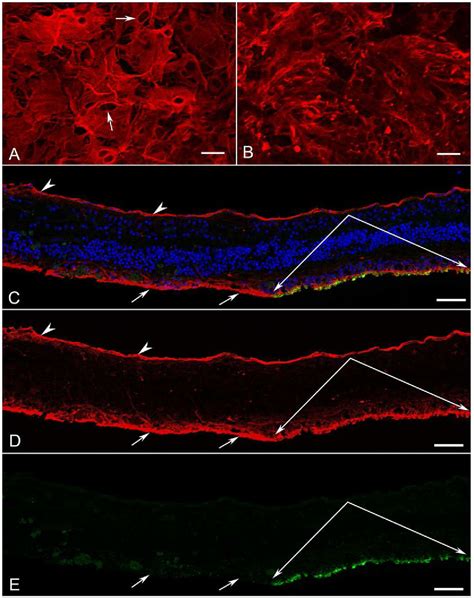 Chorioretinal Degeneration Semantic Scholar