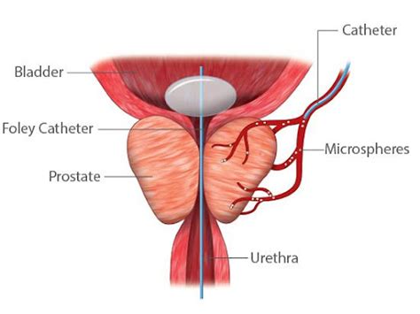 Is Pae Right For You New York City 1 Prostate Center