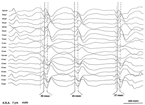 Eeg Segment With An Expanded Time Scale During Ses Left In Fig 2 In Download Scientific
