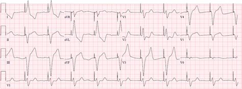 Dr Smith S Ecg Blog
