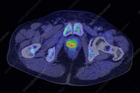 Prostate Cancer Ct Pet Scan Stock Image C0482987 Science Photo