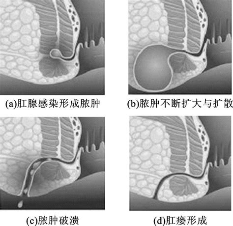 直肠肛管周围脓肿若不及时治疗可能出现什么后果 再造人