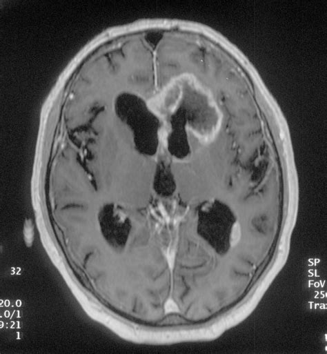 Filefrontal Lobe Tumor Wikipedia