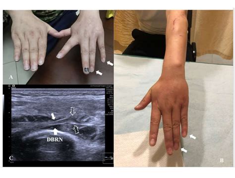 Ultrasound Guided Needle Release Combined With Corticosteroid Injection