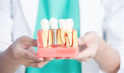 Dental Implant Recalls Sowingo