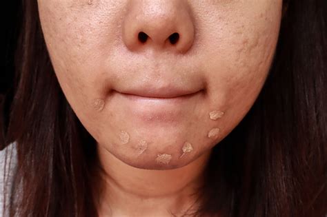 여드름 피부 문제 여드름 얼굴 피부 문제를 숨기기 위해 컨실러 메이크업을 적용하는 아시아 여성의 클로즈업 얼굴 메이크업 커버