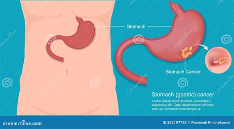 Nose Cancer Line Color Icon Human Organ Concept Malignant Neoplasm