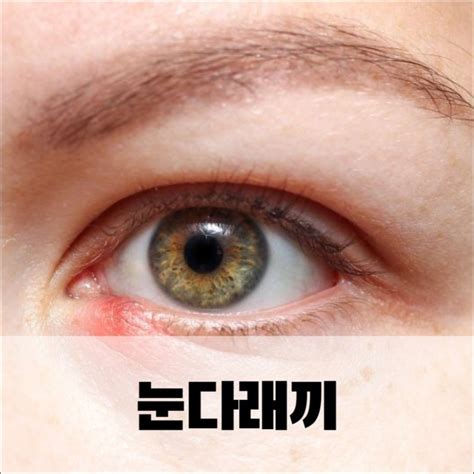 눈다래끼 났을 때 증상 치료 네이버 블로그