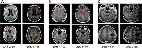 Magnetic Resonance Imaging Brain Scans Before And After Treatment With