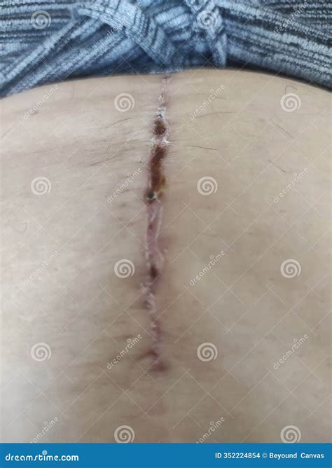 Patient Education Abdominal Hysterectomy Formal Education