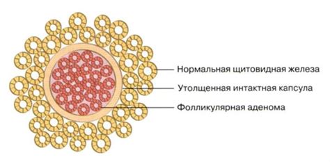 Аденома щитовидной железы что такое лечение и прогноз