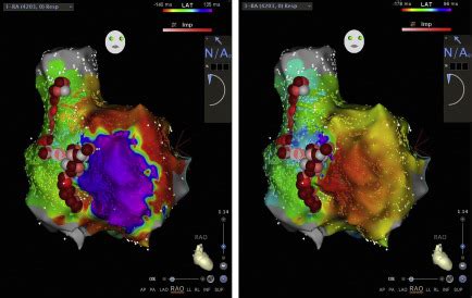 Fundamentals Of Cardiac Mapping Cardiac Electrophysiology Clinics