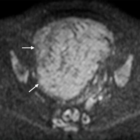 Mri Of A Female Patient With Leiomyosarcoma Axial Dwi At B 1000 Smm