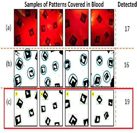 Figure 1 From Patterns Detection And Recognition In Visual Aided System For Prosthesis Pose