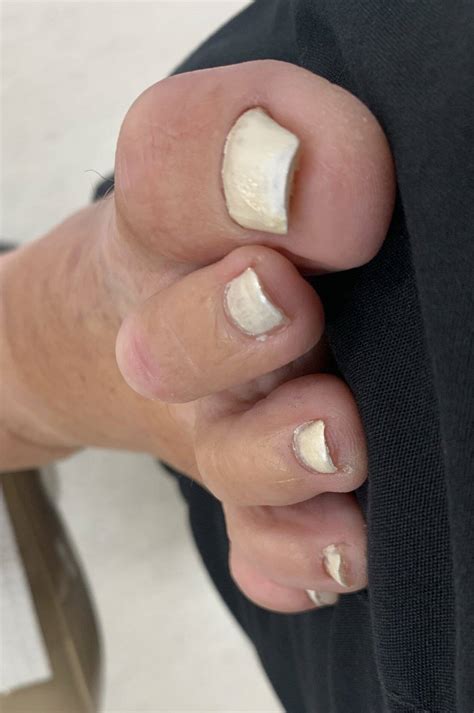Hammertoe Before And After Photos Northwest Surgery Center