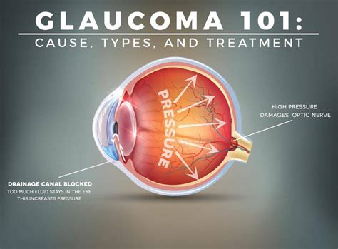 Intraocular Pressure Glaucoma Patient At Sophie Albritton Blog