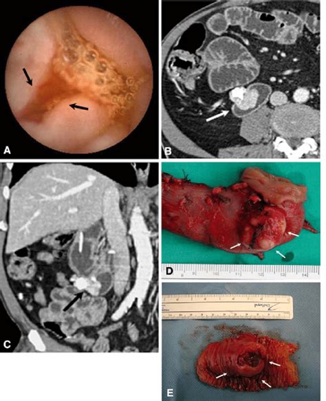 A 41 Year Old Man With A Duodenal Gist Capsule Endoscopy A Failed To Download Scientific
