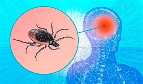 40 Facts About Tick Borne Encephalitis
