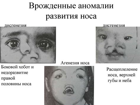 Патология носа и околоносовых пазух у детей Online Presentation