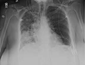 Differential Diagnosis Of Hemoptysis