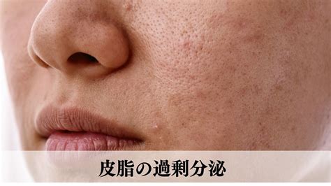 メンズ必見ニキビ対策におすすめなスキンケアをご紹介ニキビ跡は抑えれるメンズ美容塾 by BULK HOMME