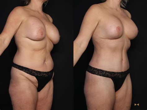 Tummy Tuck Before And After Pictures Case 608 Fort Worth And Arlington