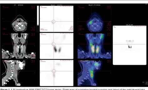 Ectopic Thyroid Tissue In Lateral Cervical Lymph Nodes A Case Report