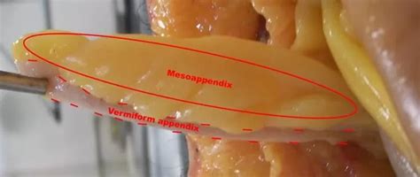 Anatomía Del Apéndice Vermiforme Gerrit Modelo Anatómico Del