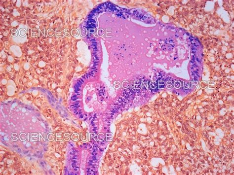 Yolk Sac Tumor Light Micrograph Stock Image Science Source Images