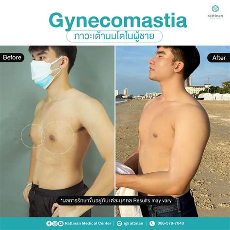 ผู้ชายมีนม Gynecomastia ภาวะเต้านมโต นมแหลมในผู้ชาย แก้ไขได้