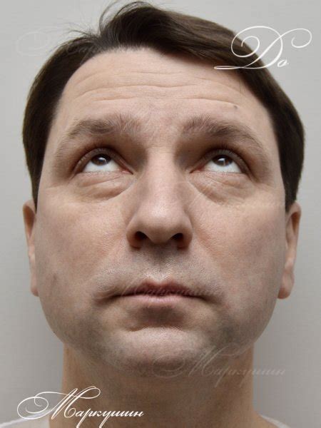 Фото до и после блефаропластики трансконъюнктивальной Пластический