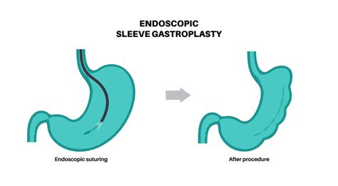 Premium Vector Endoscopic Sleeve Gastroplasty Stomach Surgery Weight