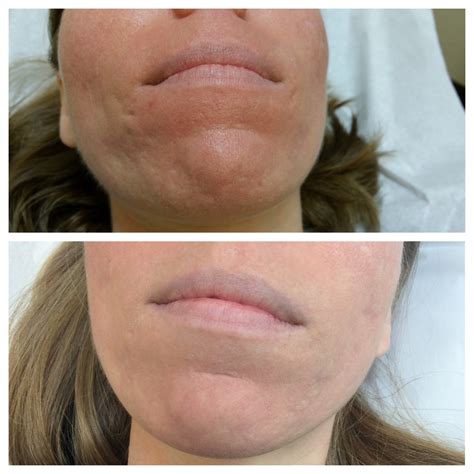Fraxel Laser Breast Reduction Scars At Albert Pietsch Blog