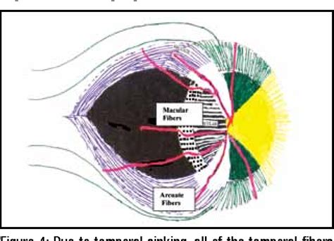 Figure 1 From Pathogenesis Of Arcuate Field Defect In Glaucoma Semantic Scholar